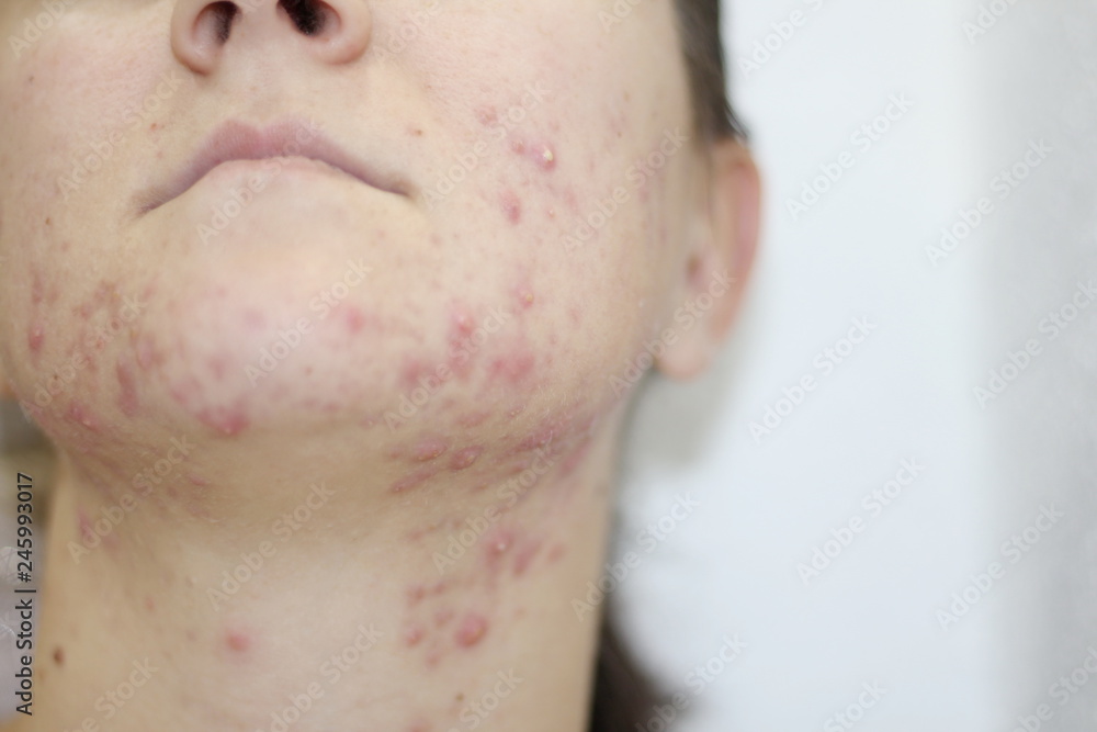 Allergy concept,young girl with problematic pimple on the face.-image ...
