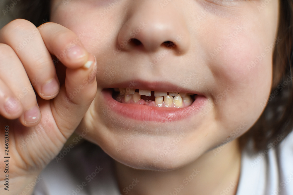 Cute little boy lost first milk tooth. Child showing his milk-tooth ...