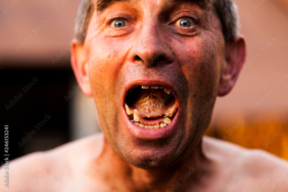 Close up of an old man showing ugly dentures. Tooth decay building up ...