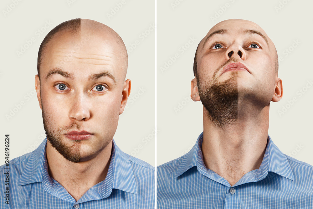 two Man before and after hair loss, alopecia on background. concept of ...