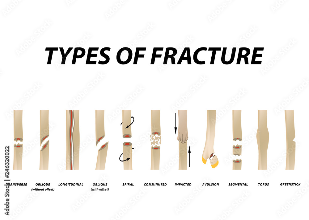 Types of fracture. Fracture bone set. Infographics. Vector illustration ...
