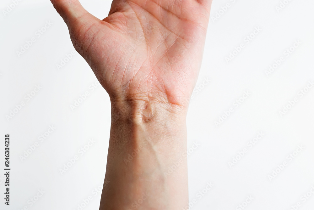 Wrist Scars