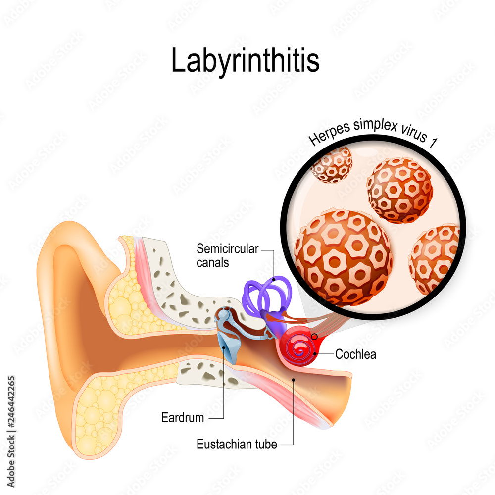 Labyrinthitis. inflammation of the inner ear and Herpes simplex virus ... Labyrinthitis. inflammation of the inner ear and Herpes simplex virus ...