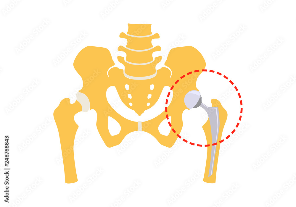 Total hip replacement. Vector illustration. Stock Vector | Adobe Stock