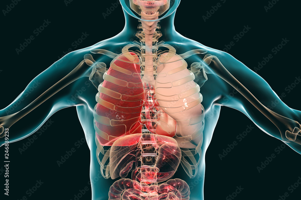 Pneumonia medical concept, 3D illustration showing lobar pneumonia of ...
