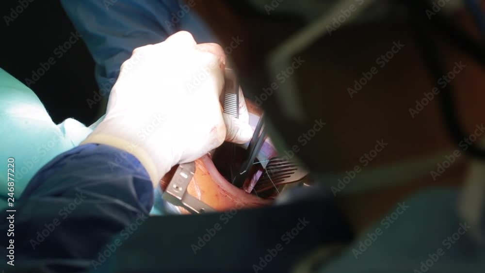 Surgeon doctor operating wearing lamp lighting electric cautery and ...