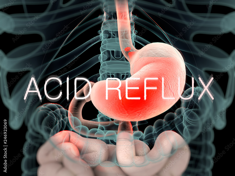 Acid reflux shown in xray view of intestines. Stomach is red. Title ...