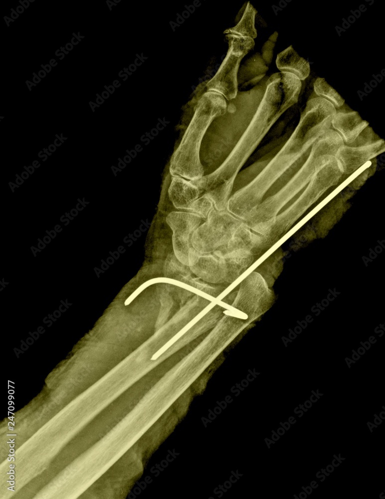 radiografia fractura del cubito y radio Stock Photo | Adobe Stock
