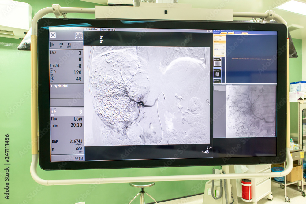 Digital Subtraction Angiography Room, DSA lab, Monitor large C-arm ...