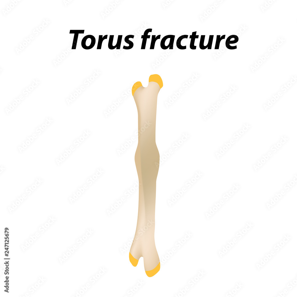 Torus fracture Bone. Infographics. Vector illustration on a lined ...
