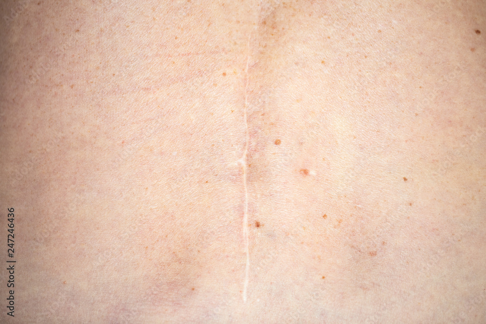 Scar on the back of an old caucasian woman after a spinal stenosis ...