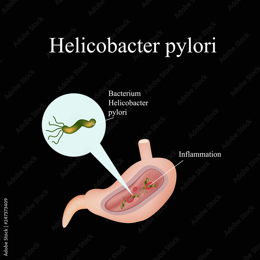Helicobacter pylori in the stomach. Infographics. Vector illustration ...