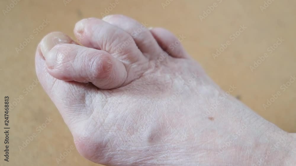 Valgus Deformity of Female Leg Due (Hallux Valgus) and Weakness of ...