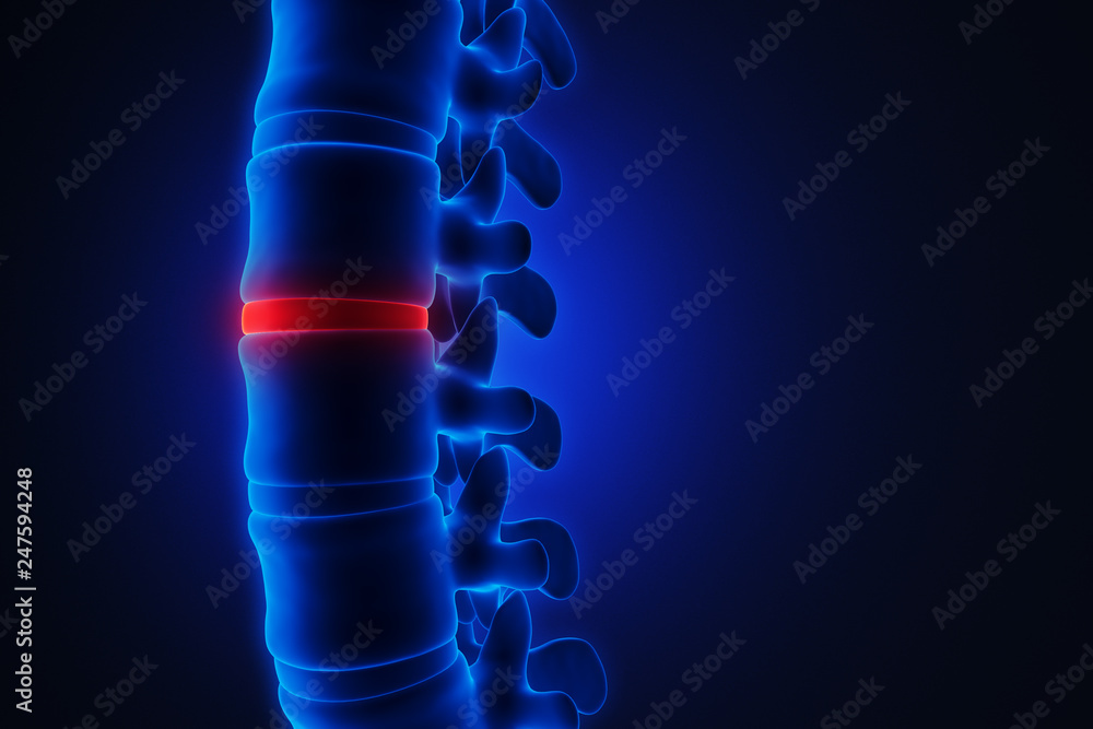 Human spinal pain concept. Thinning disk spain degradation. X-ray ...