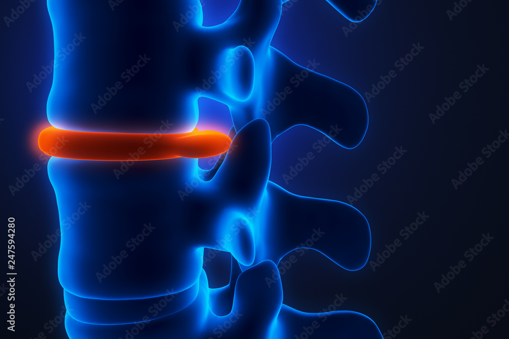 Human spinal system problem concept. Thinning disk spain degradation. X ...