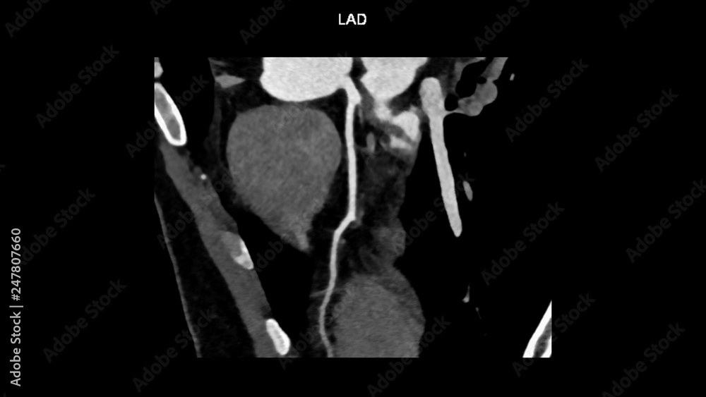 Left anterior descending (LAD, interventricular) artery branches curve ...