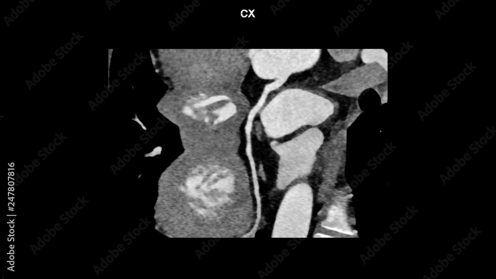 Left circumflex artery is an artery(LCX) branches curve with computed ...
