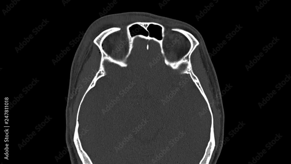 Vidéo Stock CT X-ray Scan on Human Brain fracture orbit. | Adobe Stock