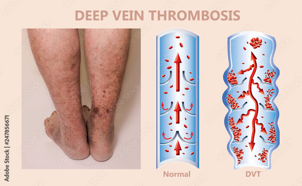 Economy class syndrome mechanism, deep vein thrombosis or DVT ...