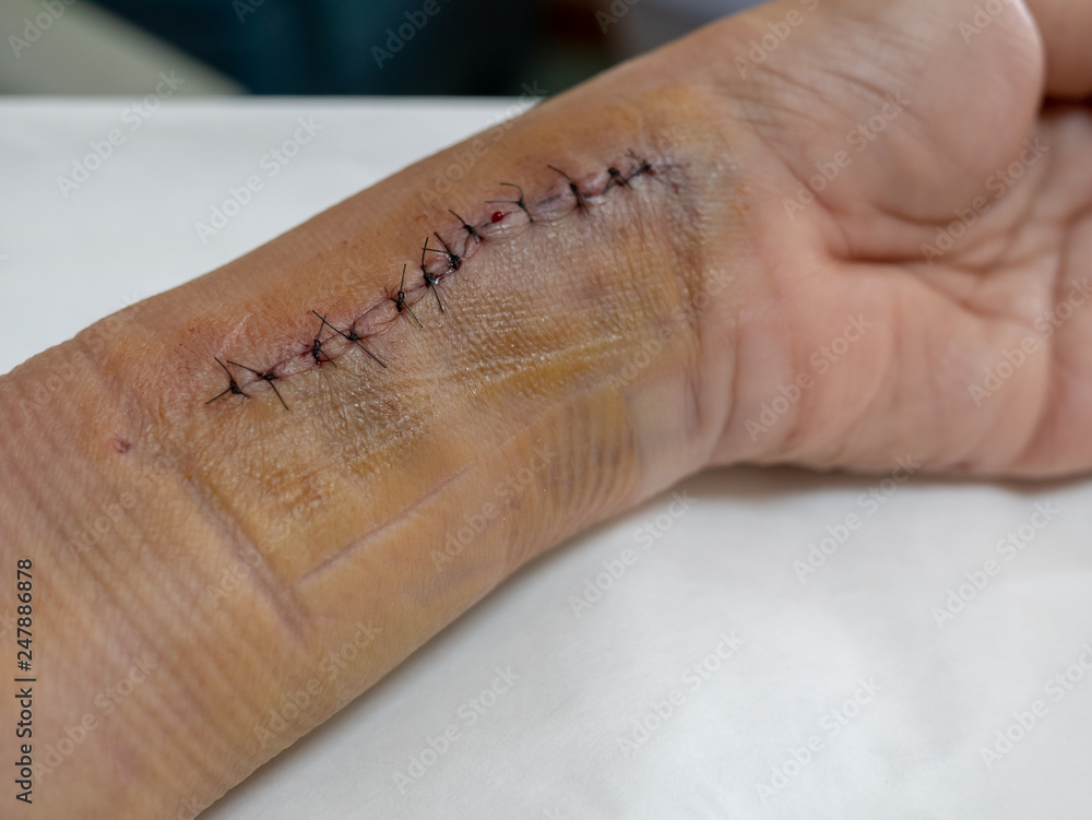 The stitches from arm surgery. Fracture of the bones. Soft of focus ...