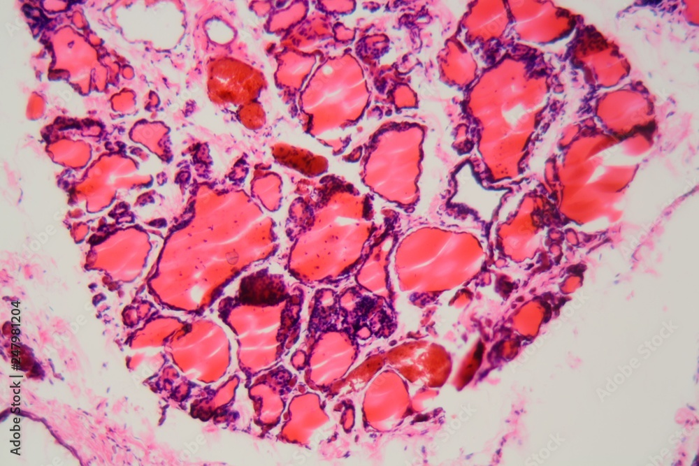 Human thyroid gland with goiter caused by deficiency of iodine under a ...