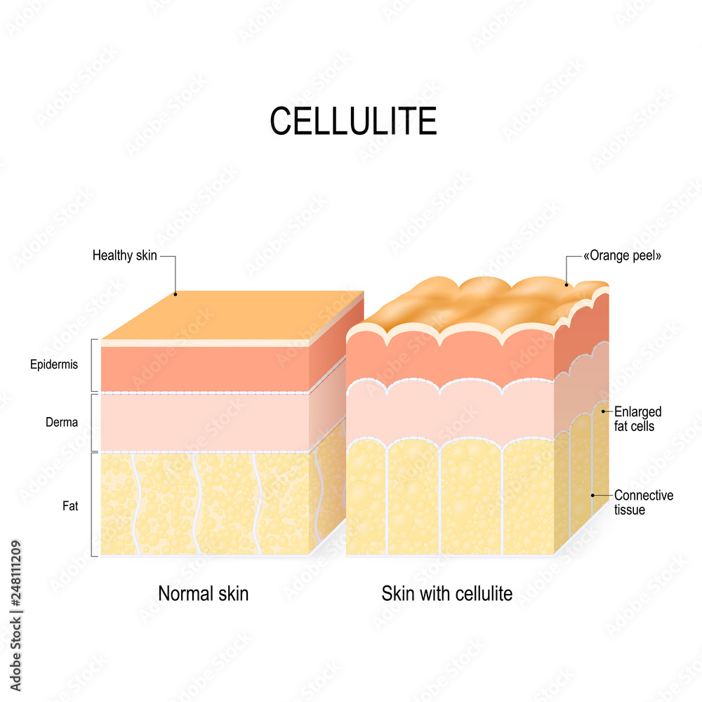 cellulite. Cross section of a healthy skin and skin with Orange peel ...
