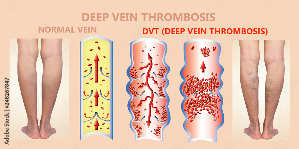 Deep Vein Thrombosis or Blood Clots. Embolus. Stock Photo | Adobe Stock