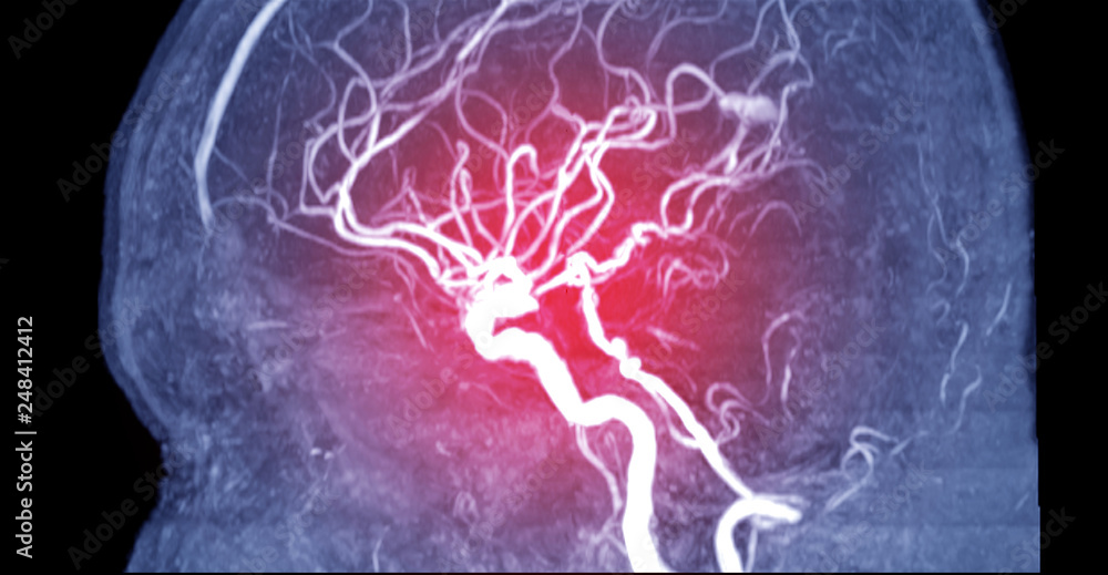 Magnetic resonance image (MRI) of Vessel in the brain sagittal view or ...