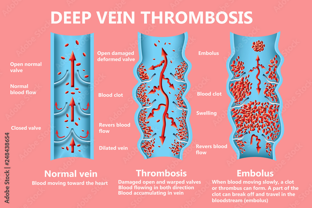 thrombosis. From Normal blood flow to Blood clot formation Stock ...
