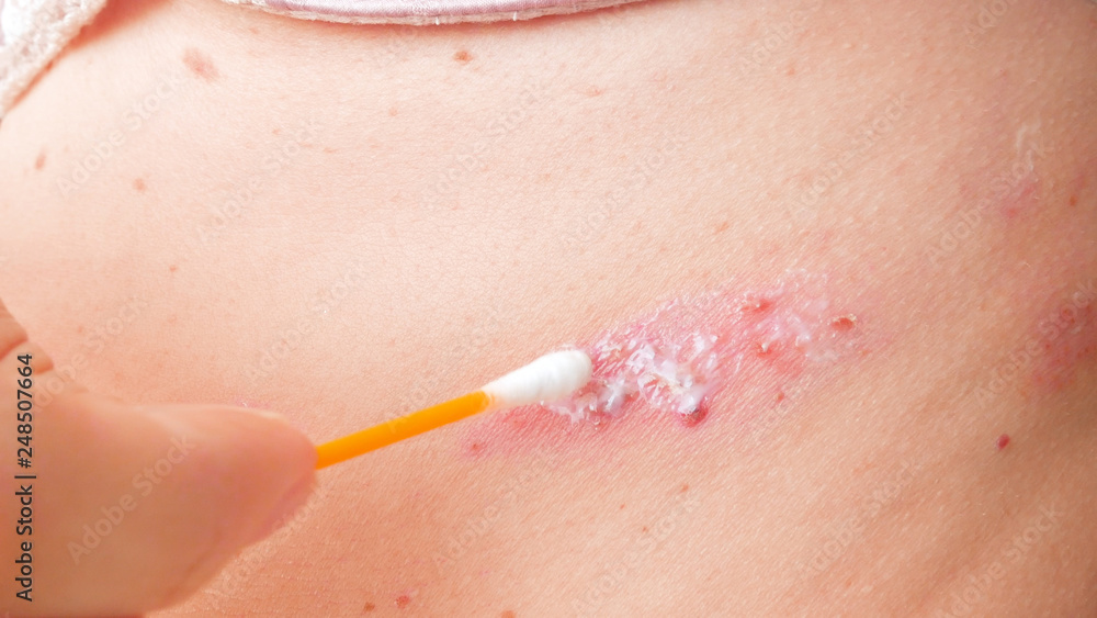 hand with cotton swab treatment of skin rash on woman body by ointment ...