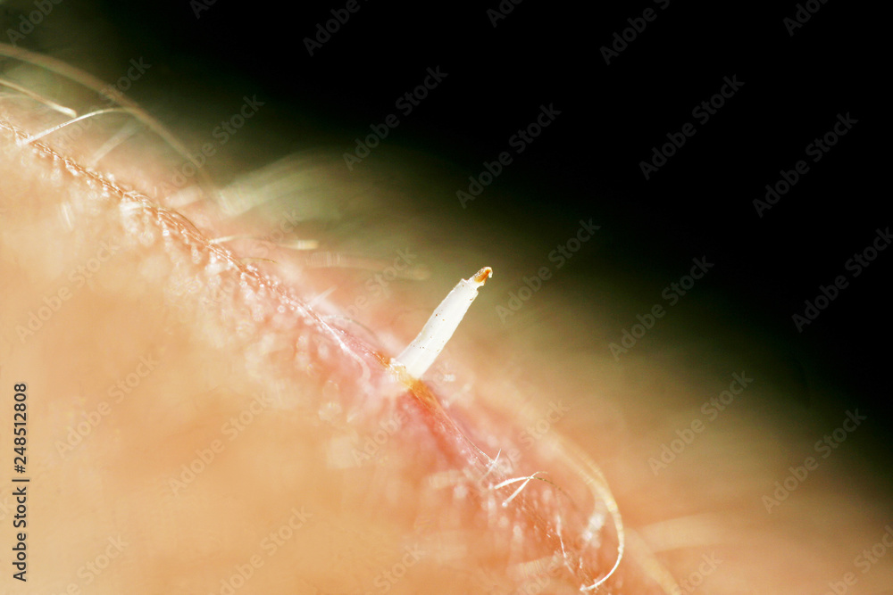 Foto de bot fly larvae inside flesh do Stock | Adobe Stock