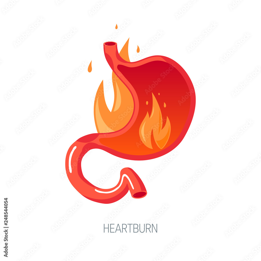 GERD concept in flat style, vector illustration Stock Vector | Adobe Stock