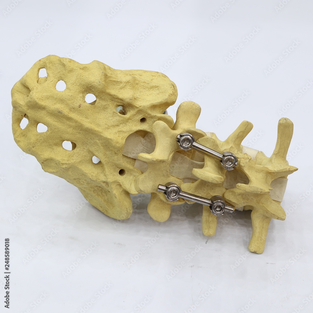 Poster Spinal fixation system - titanium bracket – Wall Art | UkPosters