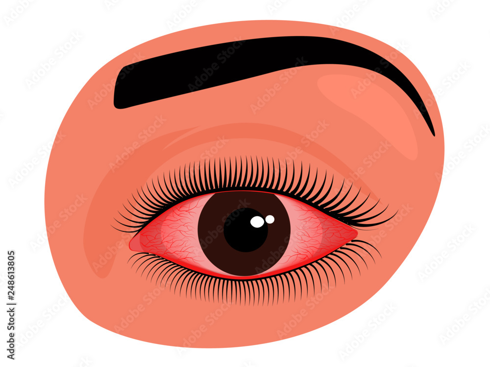 Vector illustration of irritated human eye with redness and blood ...