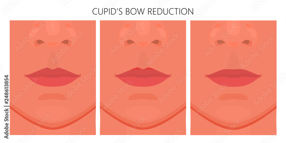 Vector illustration. Getting rid of upper lip Cupid’s bow on face ...