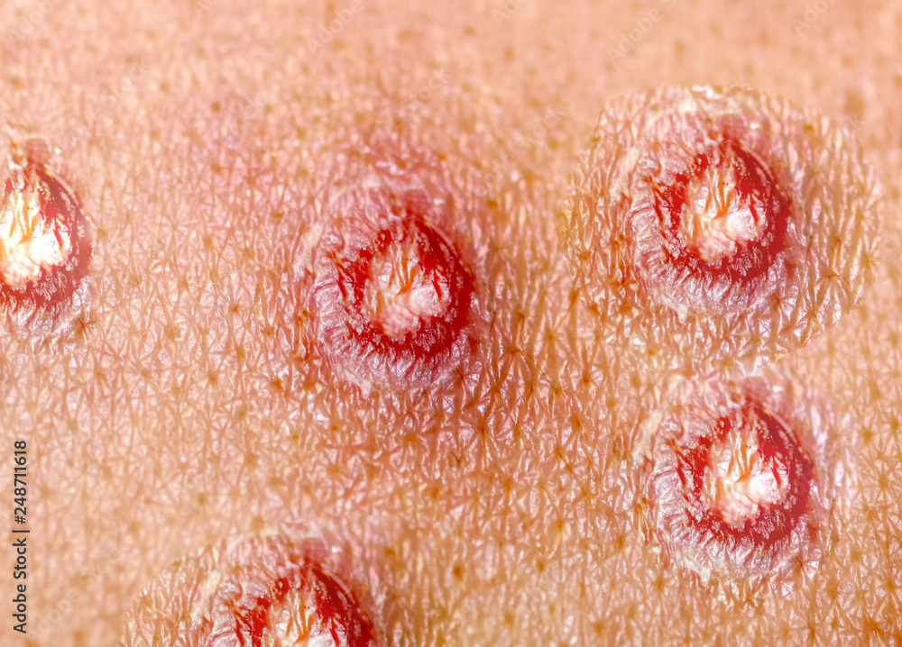 Ulcer on the skin. Smallpox. A wound, an abrasion, a cut, a scab ...