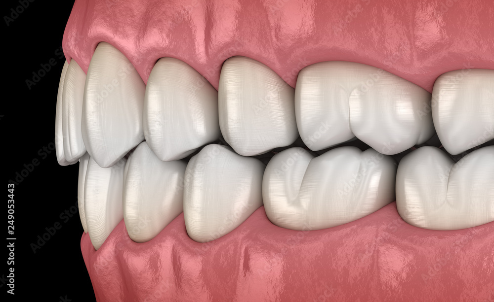 Healthy human teeth with normal occlusion, side view. Medically ...