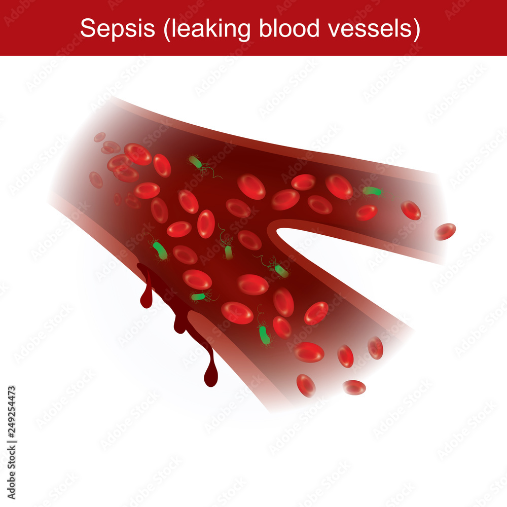 When the body has immune response to bacterial infections, causing ...