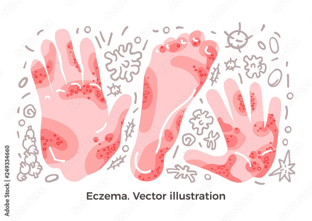 Vectorreeks. Eczeem, ziektesymptoom, bacteriën. Huiduitslag op arm ...