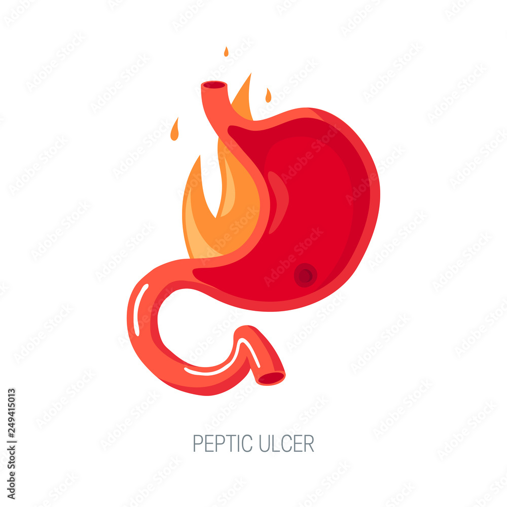 Peptic ulcer concept in flat style, vector icon Stock Vector | Adobe Stock