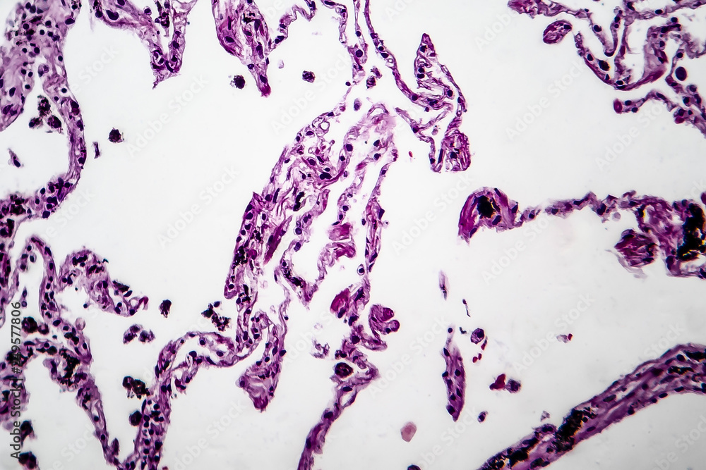 Photo & Art Print Histopathology of lung emphysema, light micrograph ...