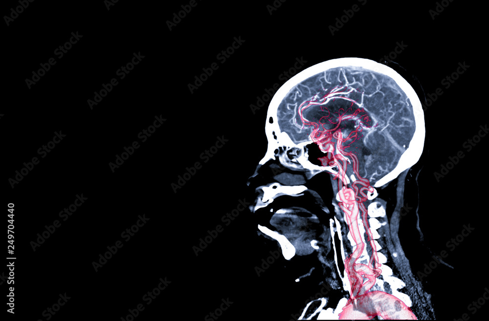 CT angiography of the brain or CTA brain comparison Coronal and ...