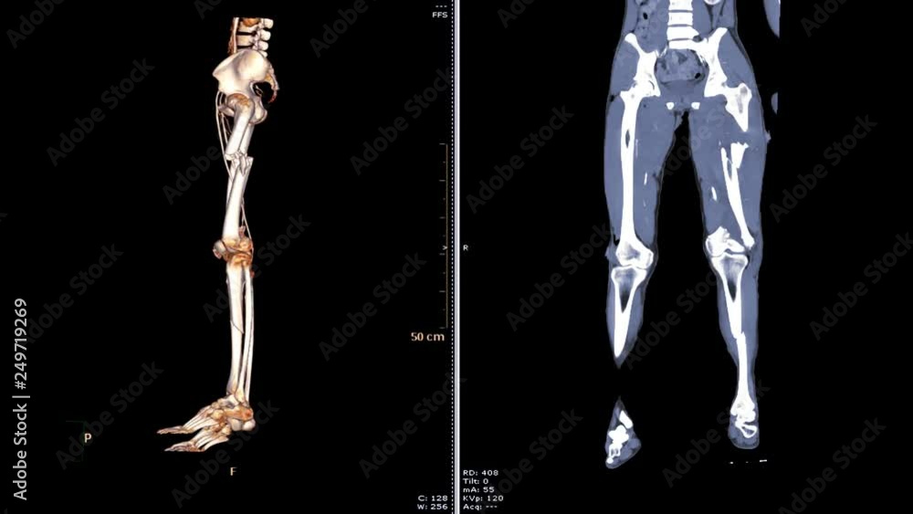 CTA femoral artery run off 3D rendering image VS 2D coronal view of ...