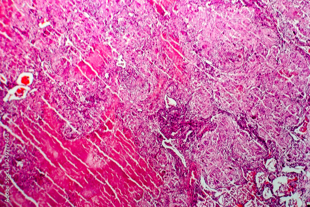 Miliary tuberculosis, light micrograph, photo under microscope Stock ...