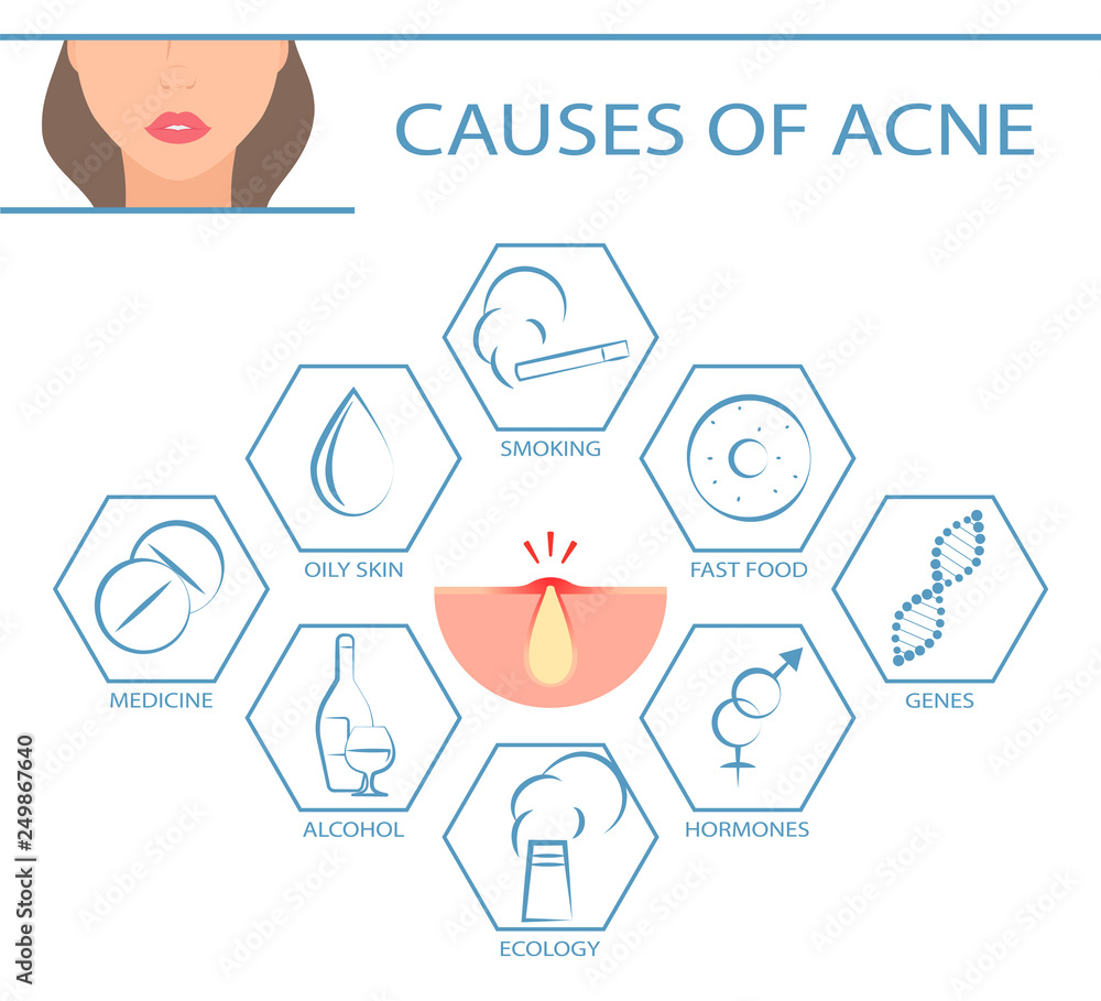 Causes of acne. Dermatology, skin problems, comedonal acne. Causes of ...