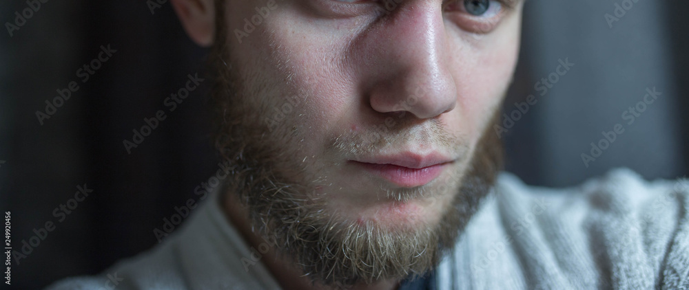 trauma of the nose in a man. swollen face from allergies, angioedema ...