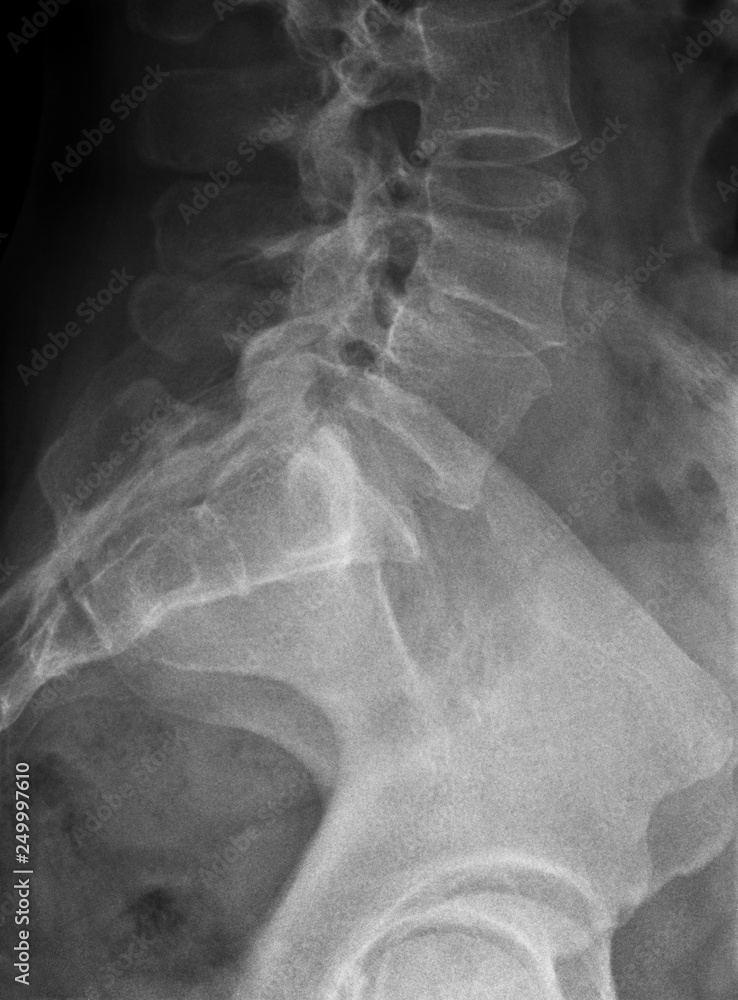 X-ray picture - backbone Stock Photo | Adobe Stock