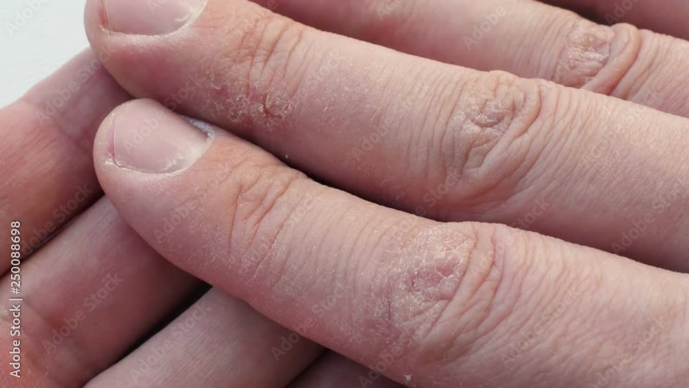 Fingers with dry cracked skin. Hands with dermatology problems. Stock ...