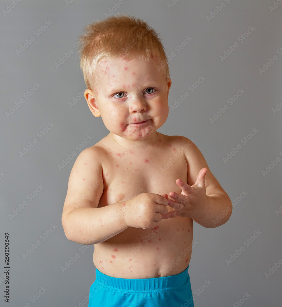 Little boy with the allergy symptoms skin rash of the body and face ...
