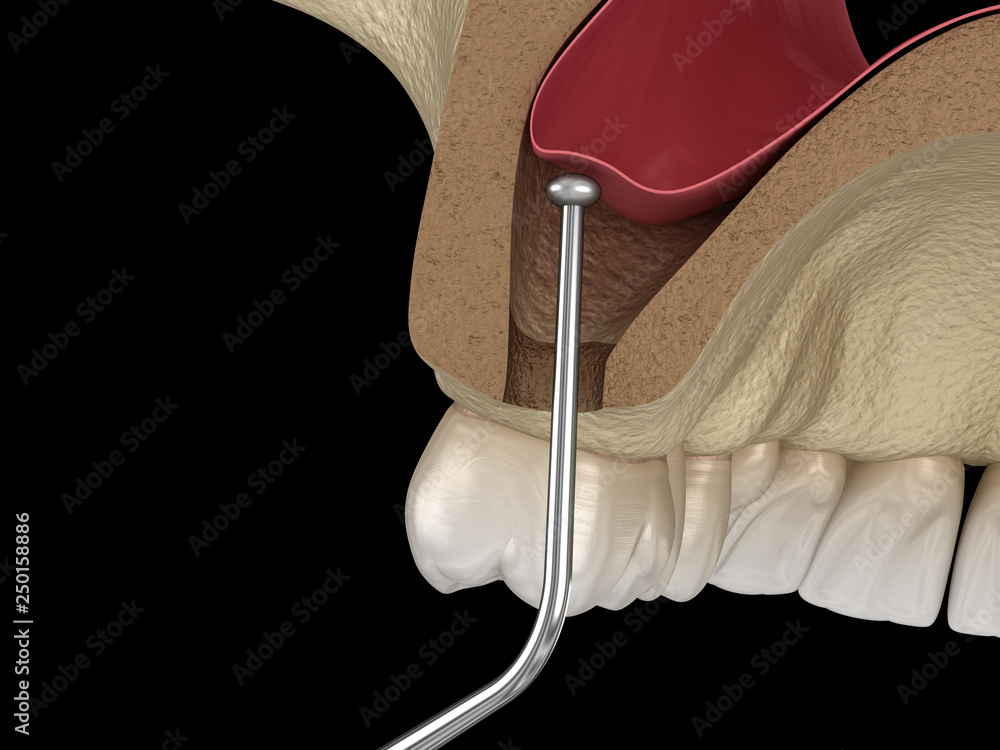 Sinus Lift Surgery - Creating an access to the Sinus. 3D illustration ...